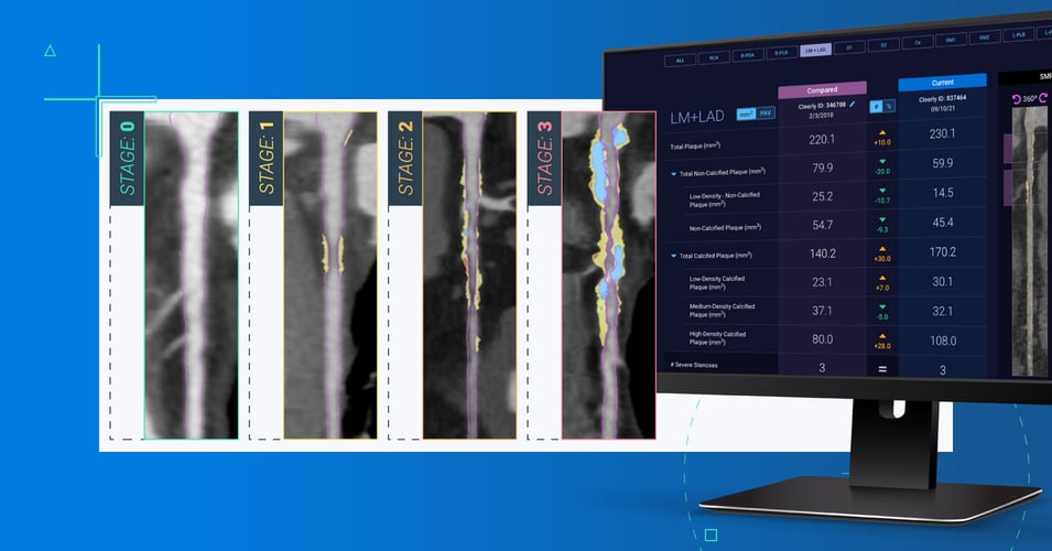 Heart Health Blog | Cleerly, Inc | AI-enabled CCTA approach