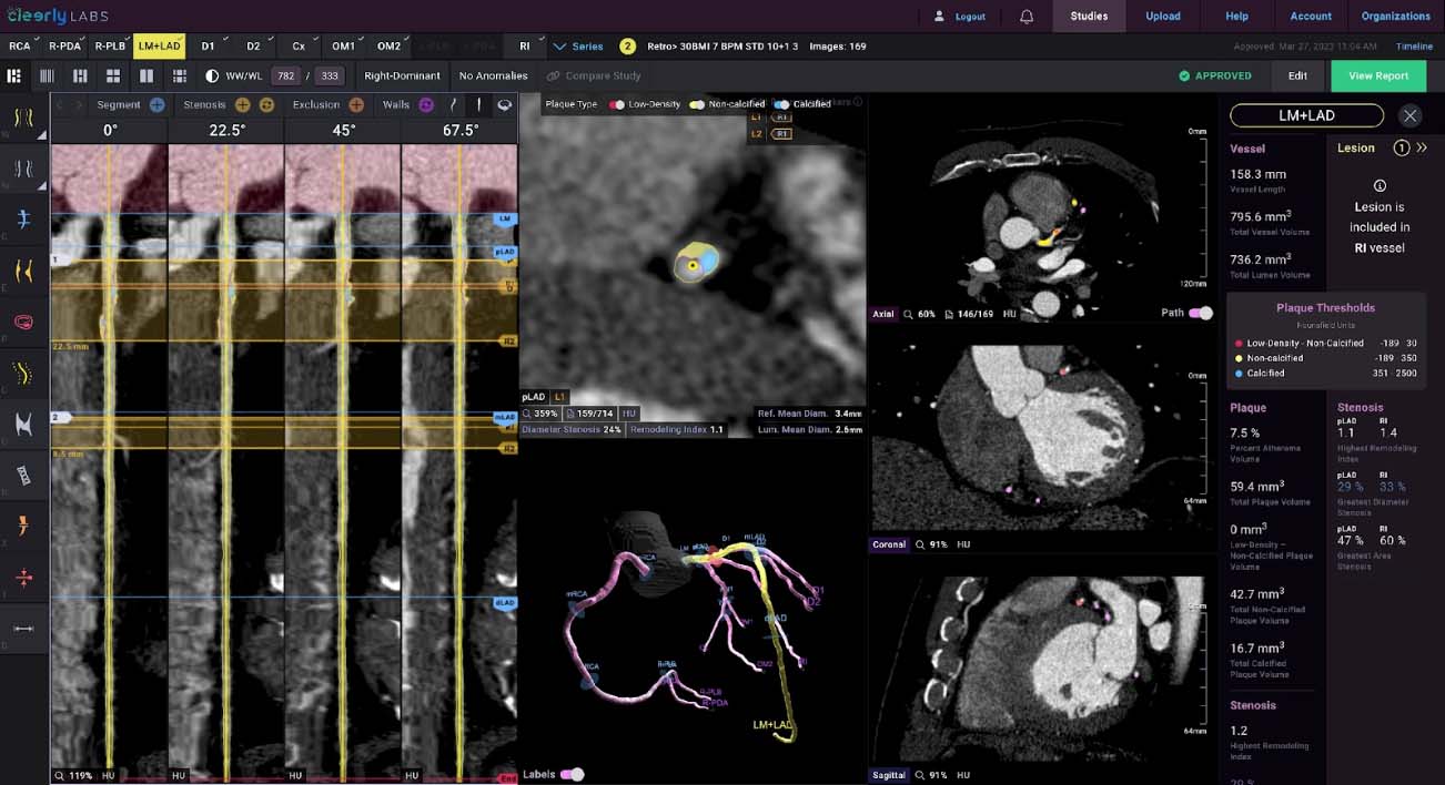 What is Cleerly | Cleerly Coronary CT Scan Analysis