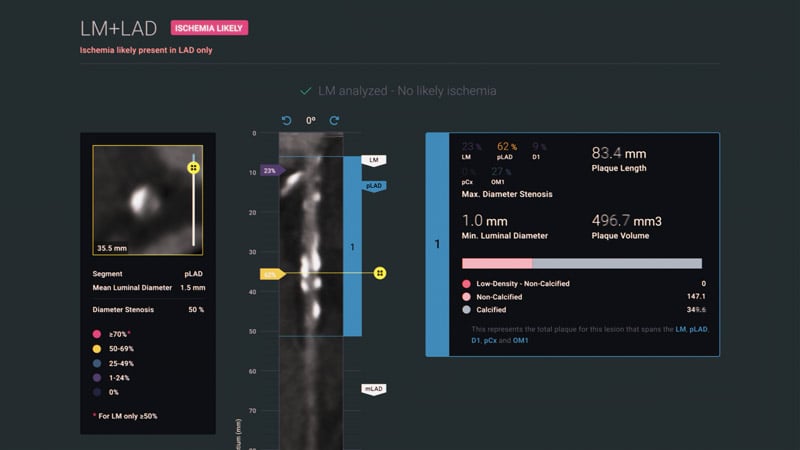 Cleerly Atherosclerosis, Stenosis and Ischemia Analysis