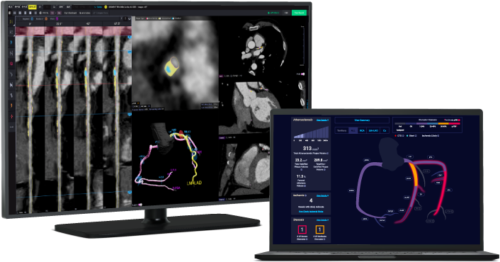 Patient Education: Cleerly Plaque Analysis for Heart Disease Detection