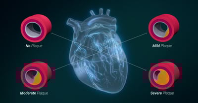 Patient Education: Cleerly Plaque Analysis for Heart Disease Detection