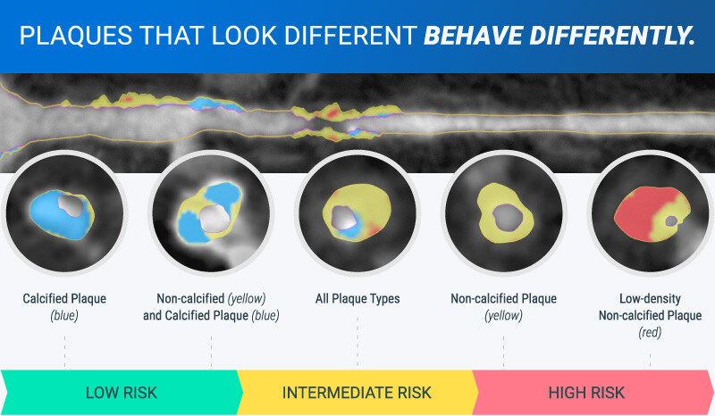 Cleerly Coronary Plaque Analysis