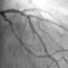 Cleerly Coronary Plaque Analysis